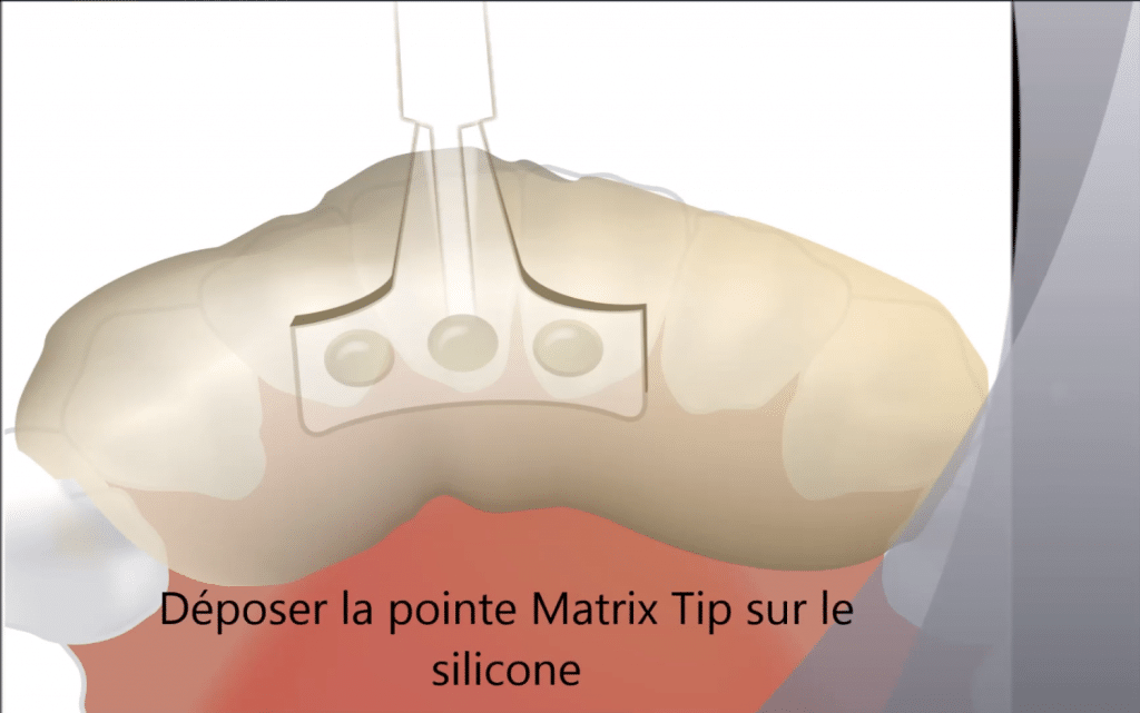 Fast Splint Matrix - Bio Composants Médicaux