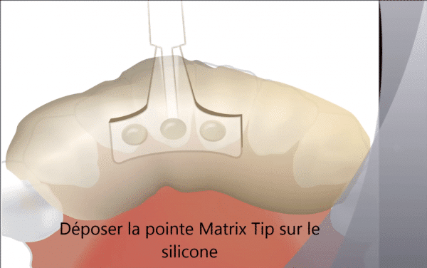 Fast Splint Matrix - Bio Composants Médicaux