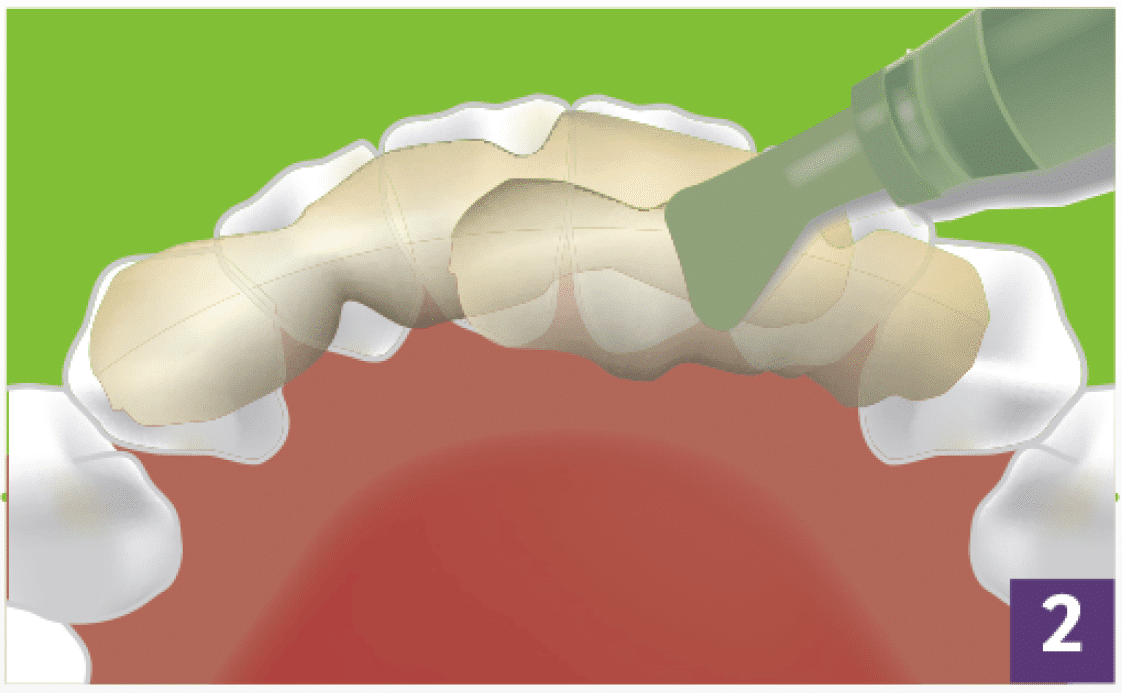 Fast Splint Matrix laboratory - Bio Composants Médicaux